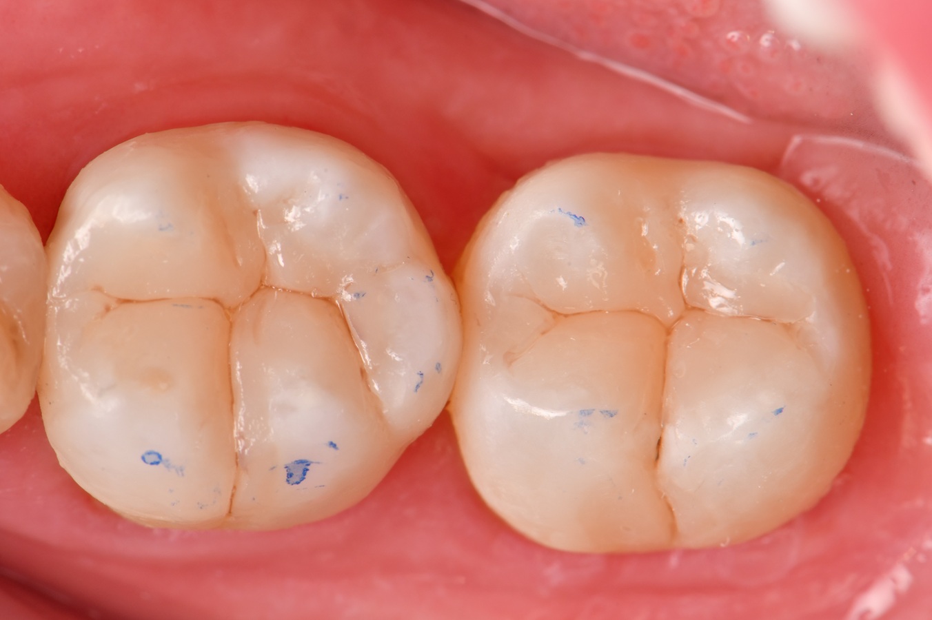 Band in band matrix technique for back to back Class II restorations