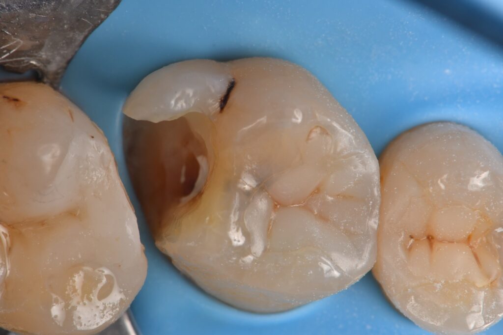 Challenging DO restoration on a first molar due to position