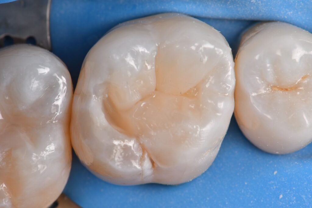 Class I replacement using direct composite