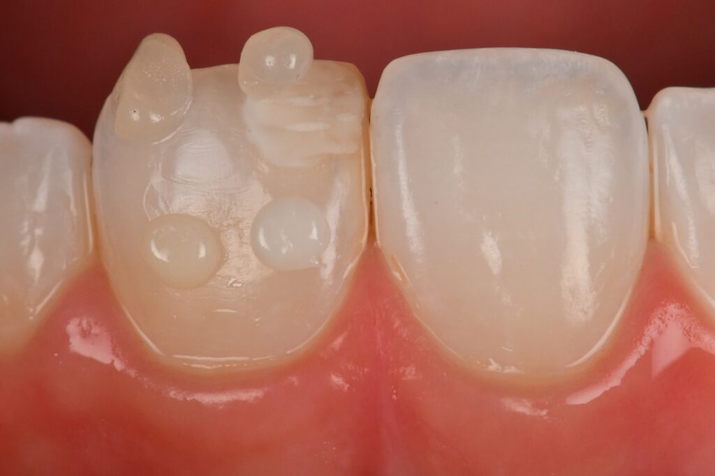 Class IV Invisible Composite Restoration