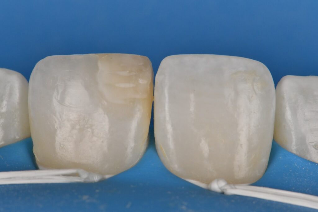 Class IV Invisible Composite Restoration