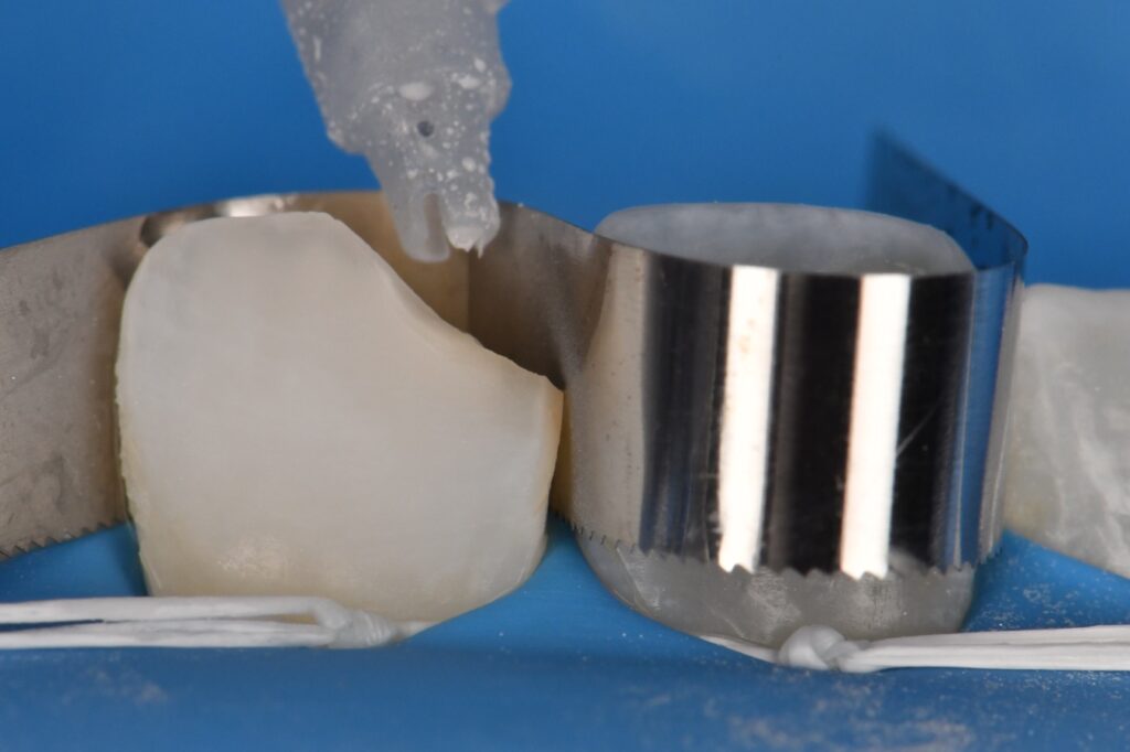 Class IV Invisible Composite Restoration