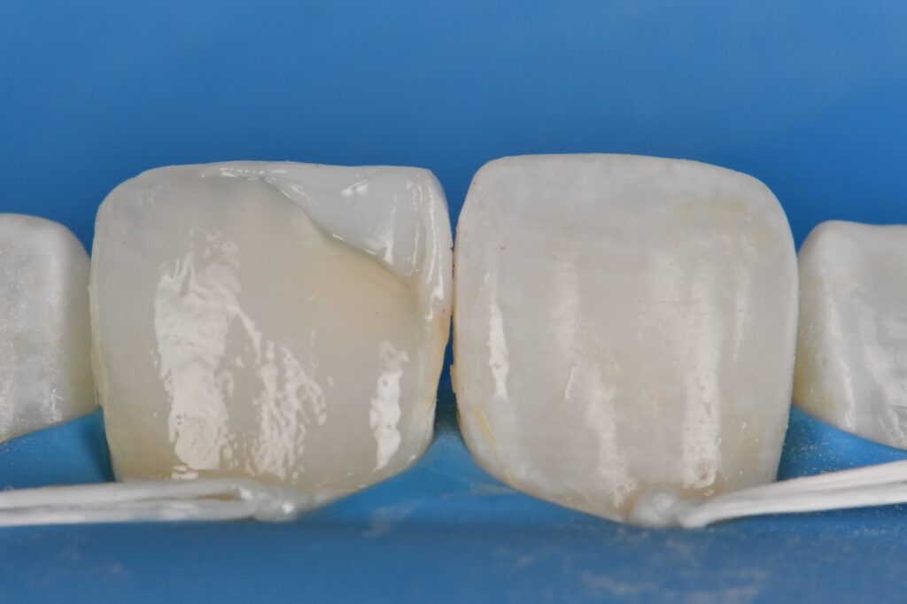 Class IV Invisible Composite Restoration