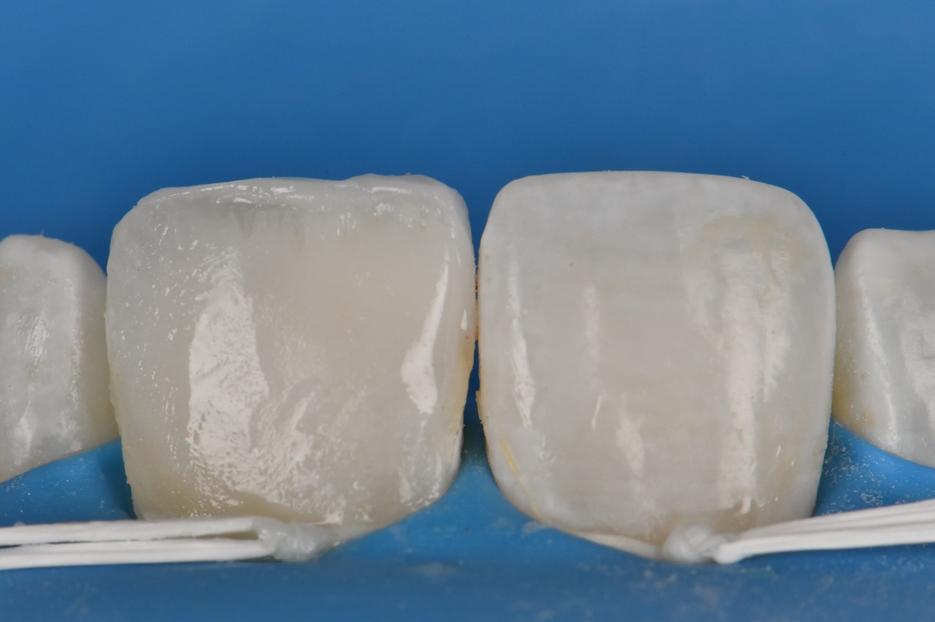 Class IV Invisible Composite Restoration