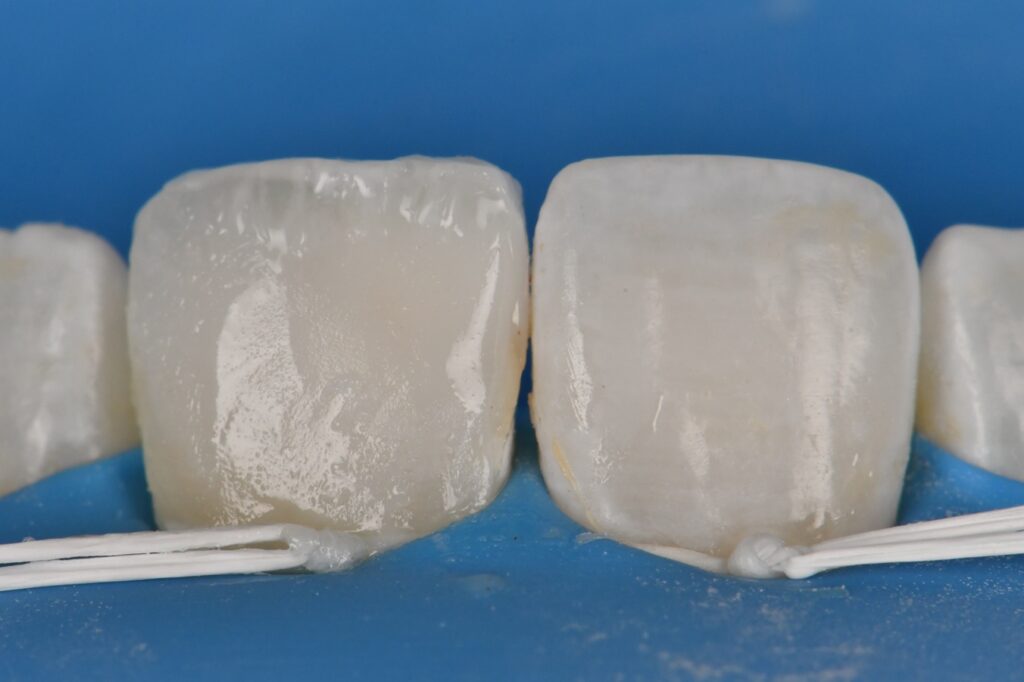 Class IV Invisible Composite Restoration