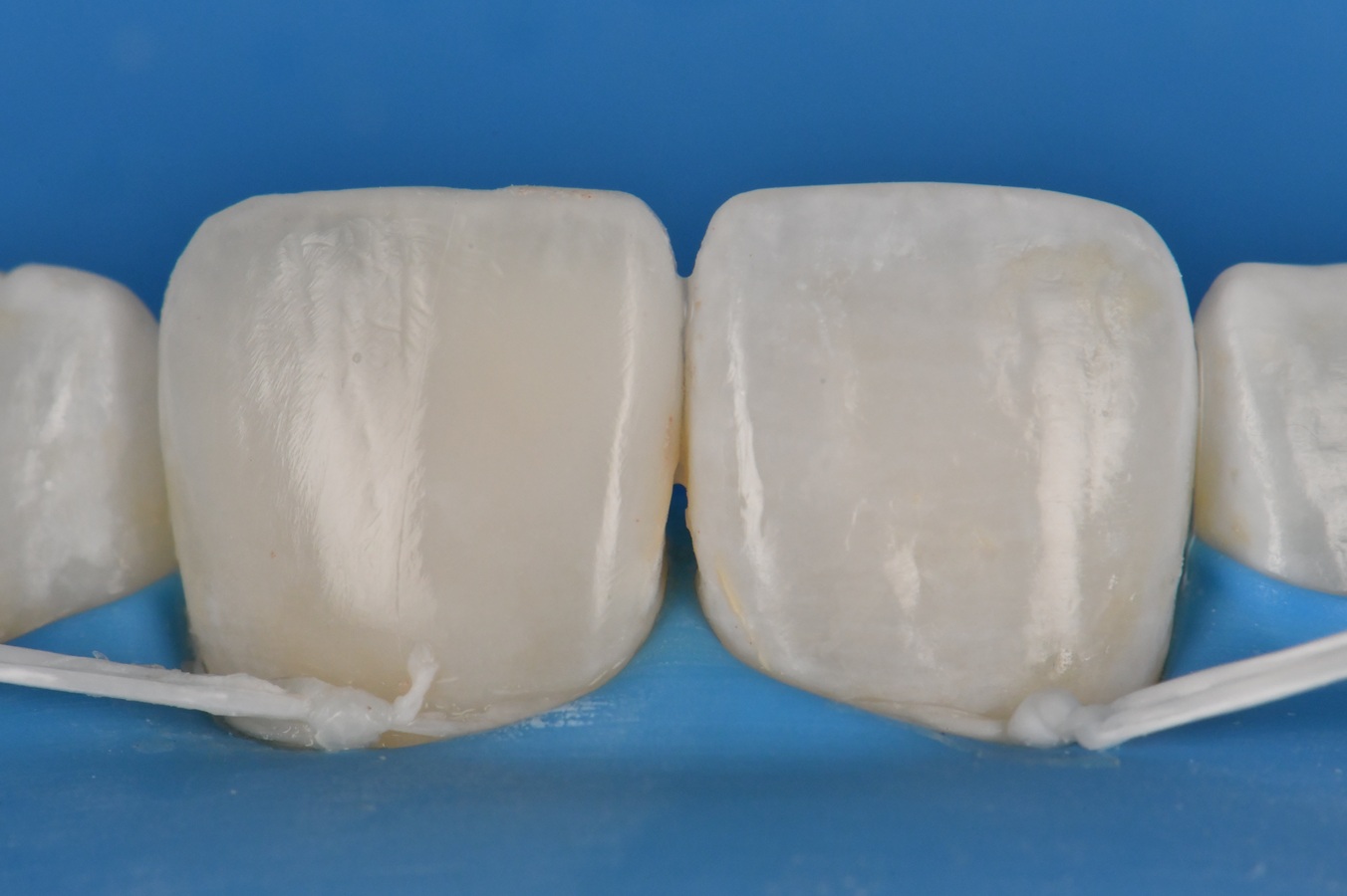 Class IV Invisible Composite Restoration