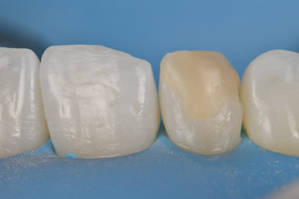 Voco Amaris Stratified Natural Appearance Composite Restorations