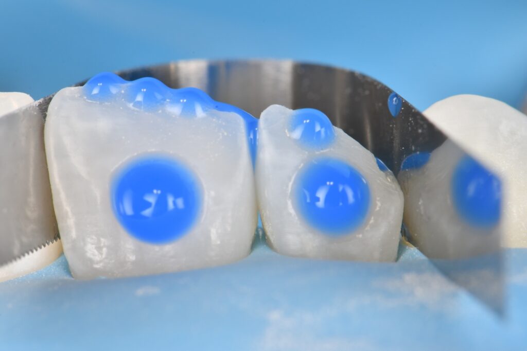 Voco Amaris Stratified Natural Appearance Composite Restorations