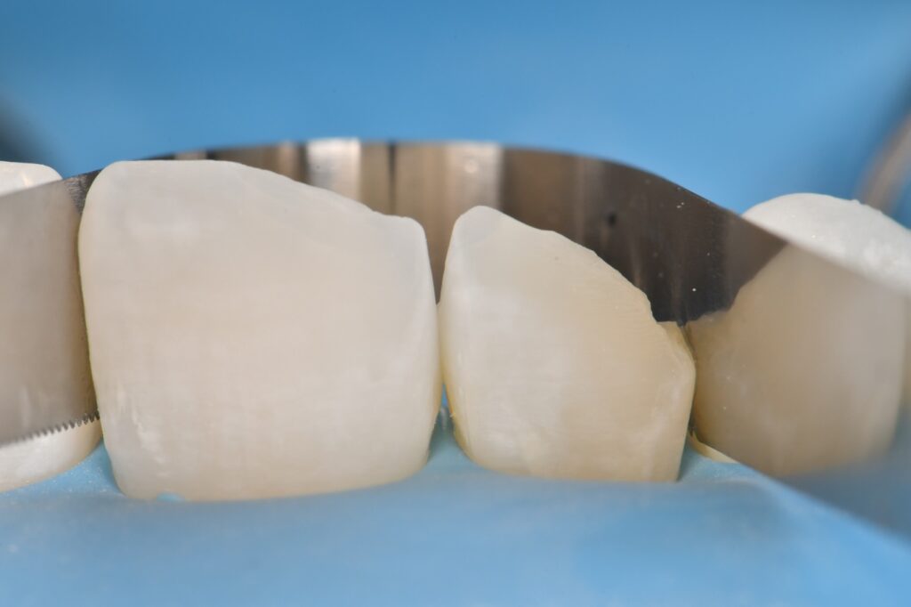 Voco Amaris Stratified Natural Appearance Composite Restorations