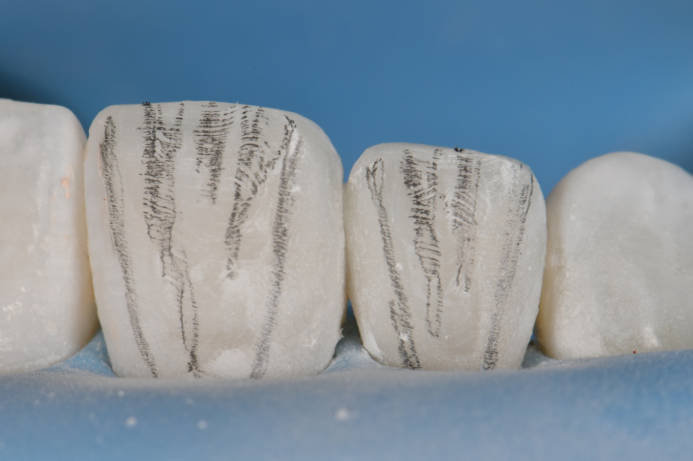 Voco Amaris Stratified Natural Appearance Composite Restorations
