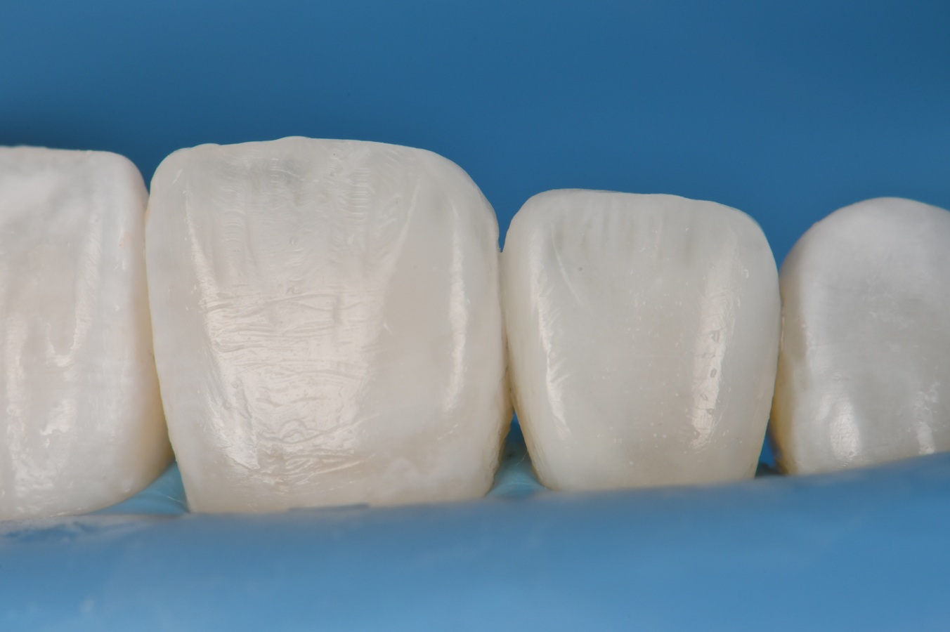 Voco Amaris Stratified Natural Appearance Composite Restorations