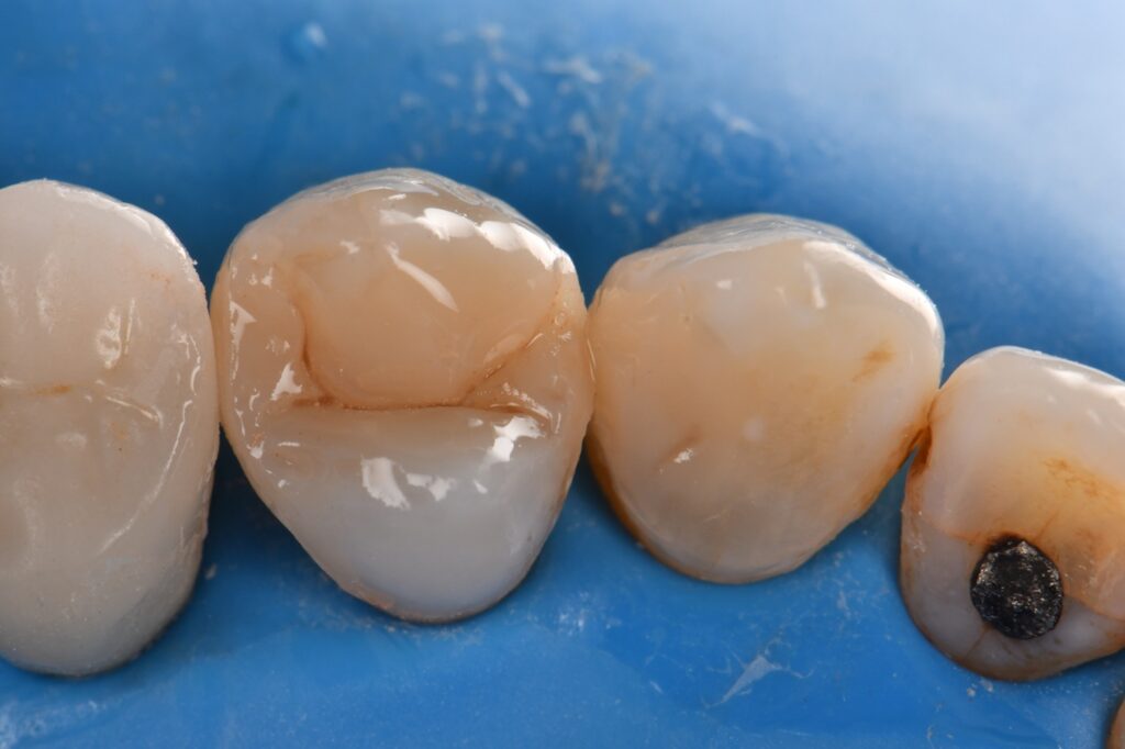 Creating Seamless Natural Composite Restorations