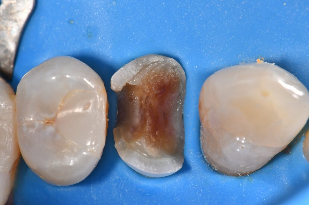 Complex Reconstruction in Composite Resin