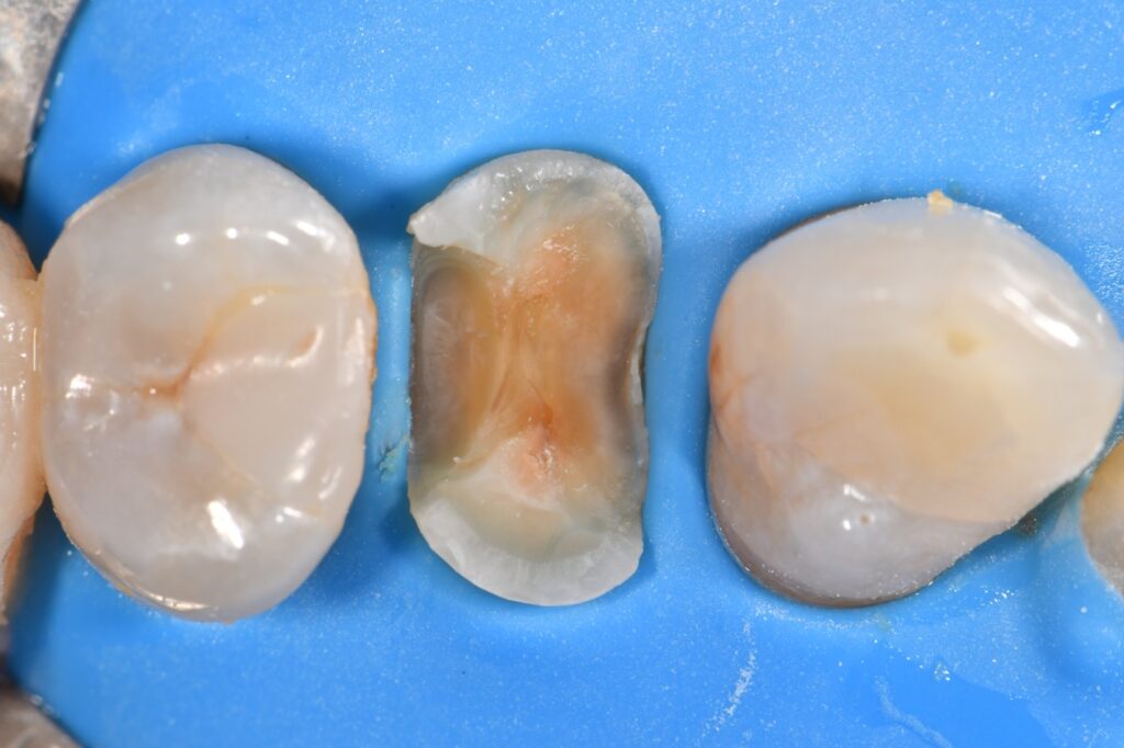Complex Reconstruction in Composite Resin