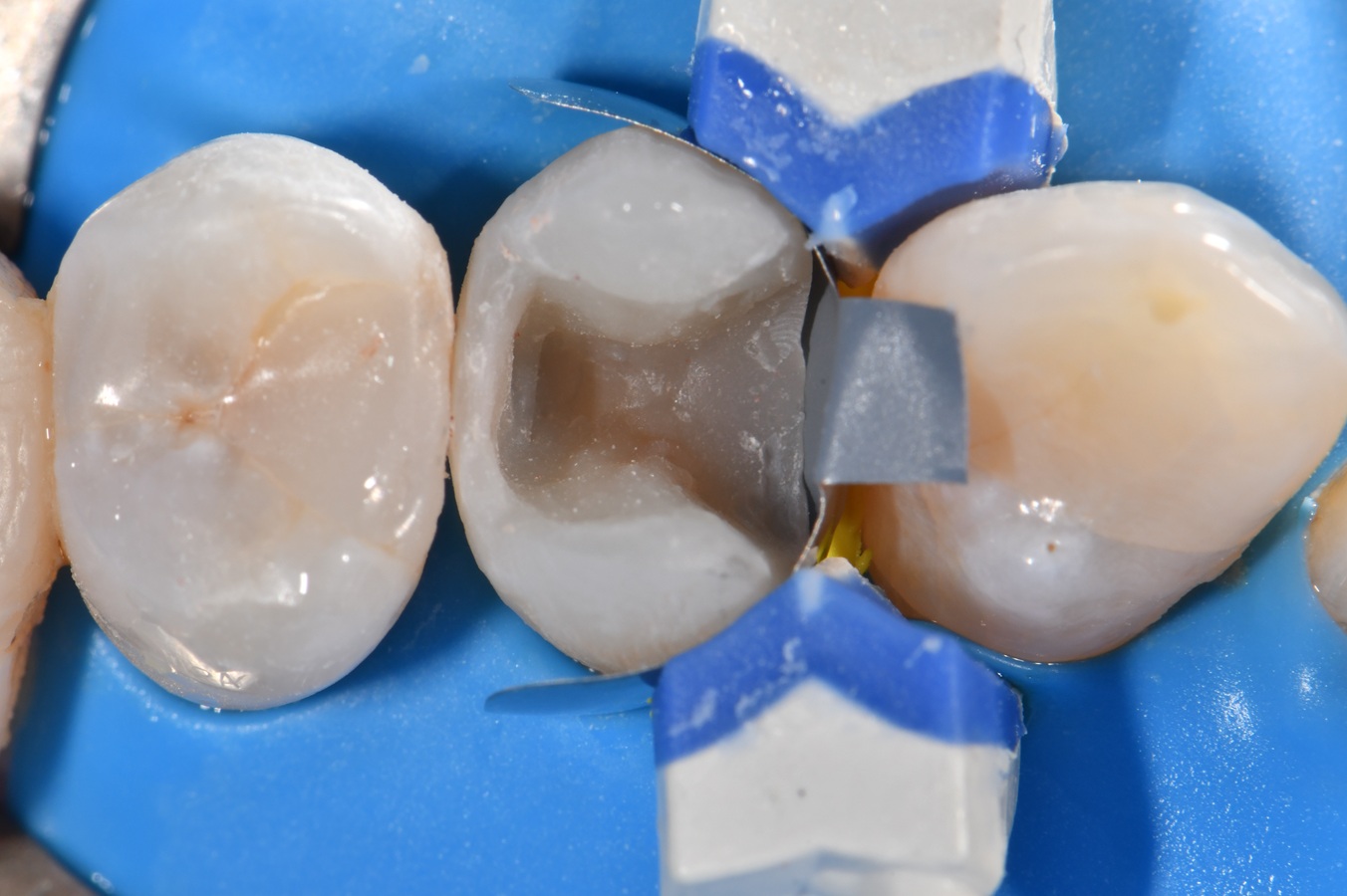 Complex Reconstruction in Composite Resin