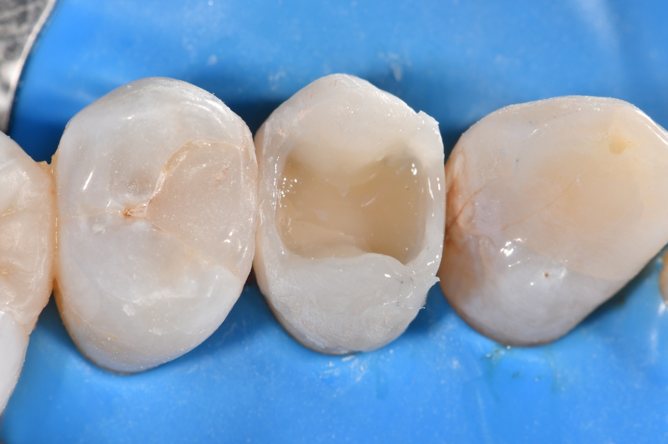 Complex Reconstruction in Composite Resin