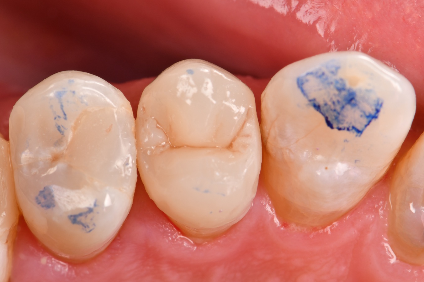 Complex Reconstruction in Composite Resin