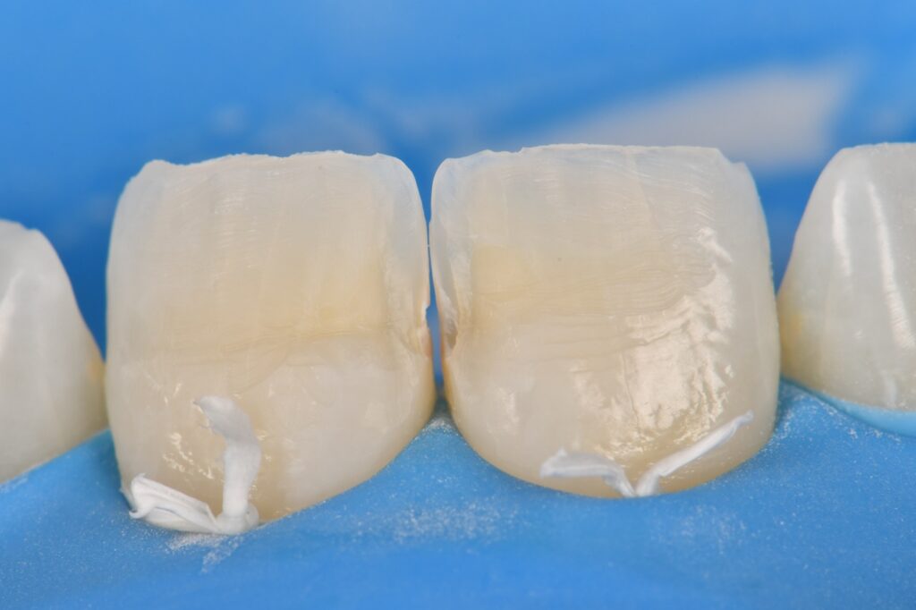 Direct Composite Bonding to Repair extensive enamel fractures