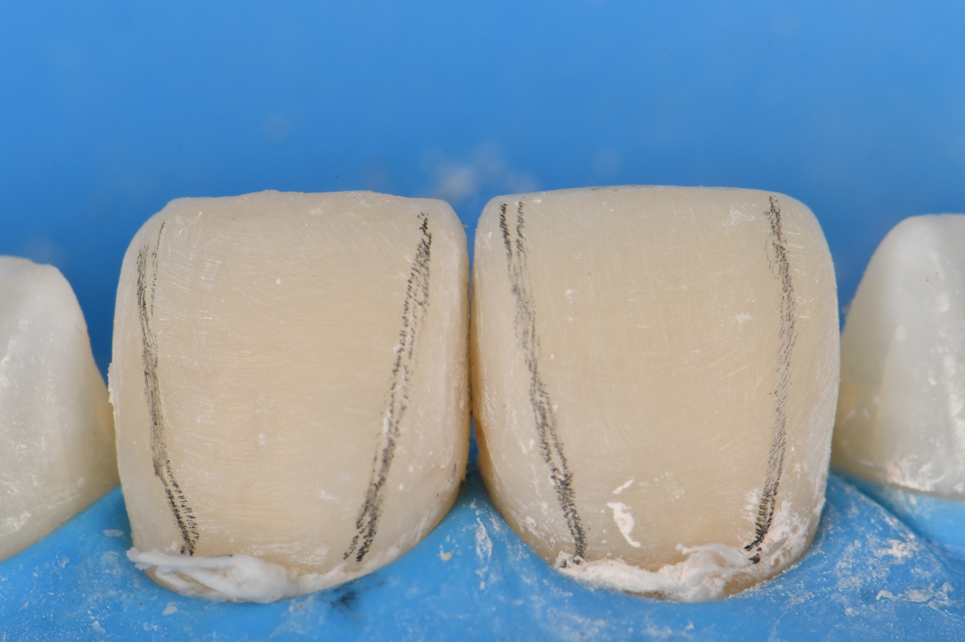 Direct Composite Bonding to Repair extensive enamel fractures