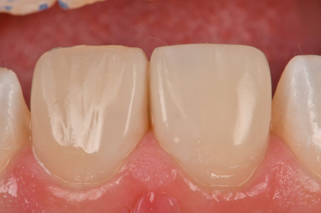 Direct Composite Bonding to Repair extensive enamel fractures