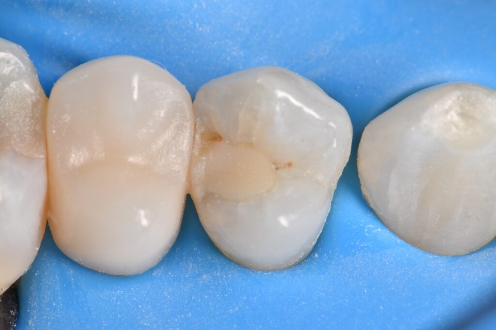 Unbeatable Class II restorative solution with Grandio SO and Garrison