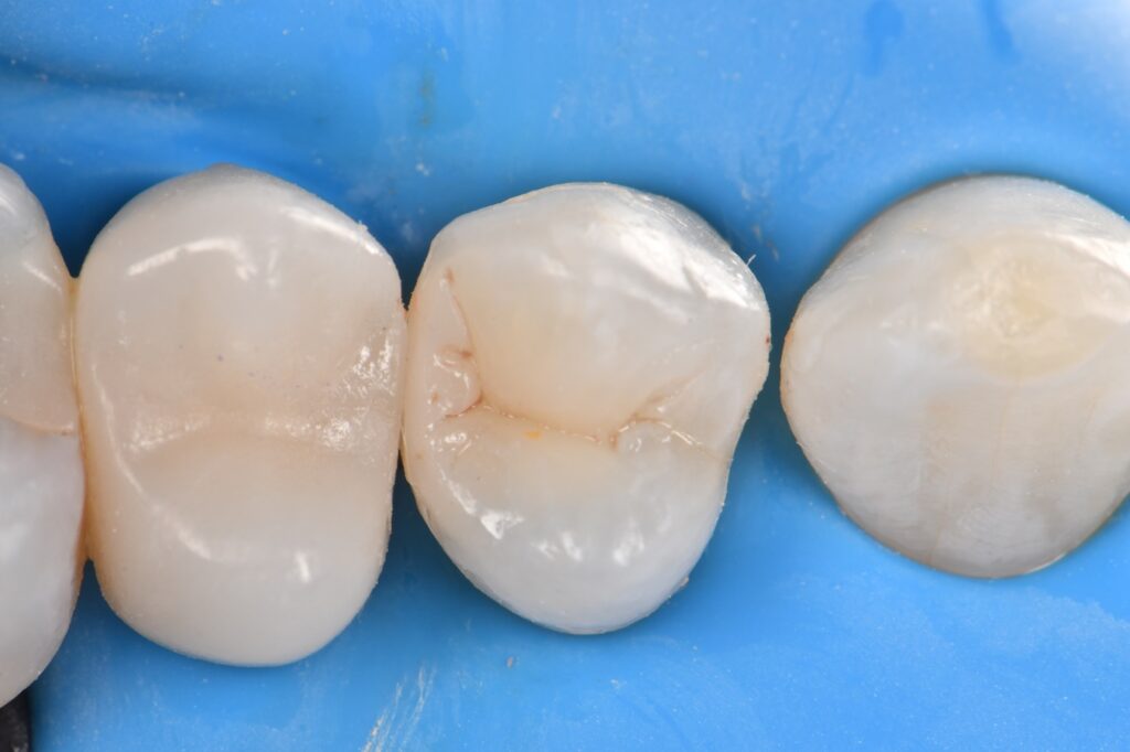 Unbeatable Class II restorative solution with Grandio SO and Garrison