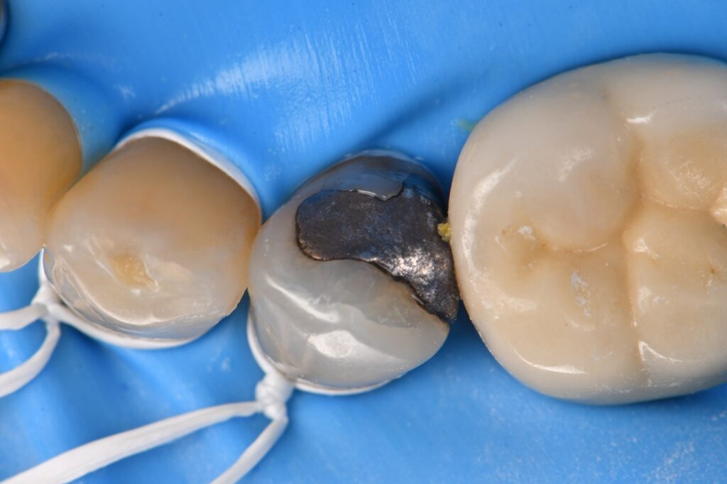 Garrison Quad Matrix system in Class II restorative situation