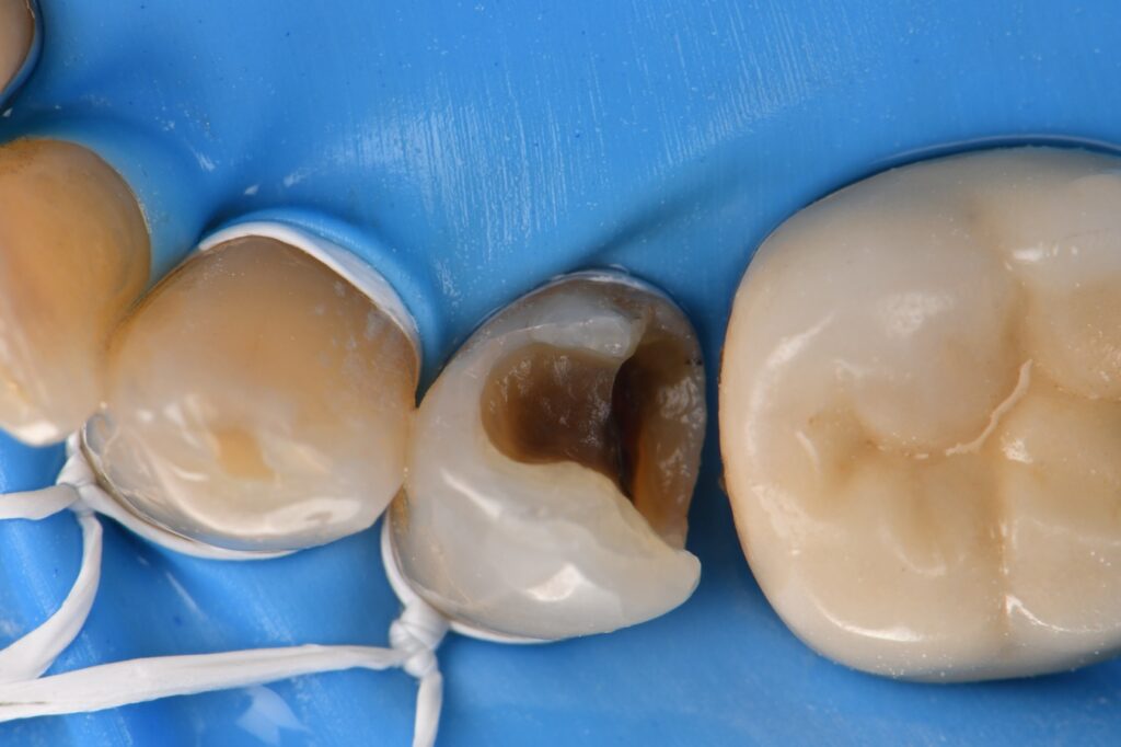Garrison Quad Matrix system in Class II restorative situation