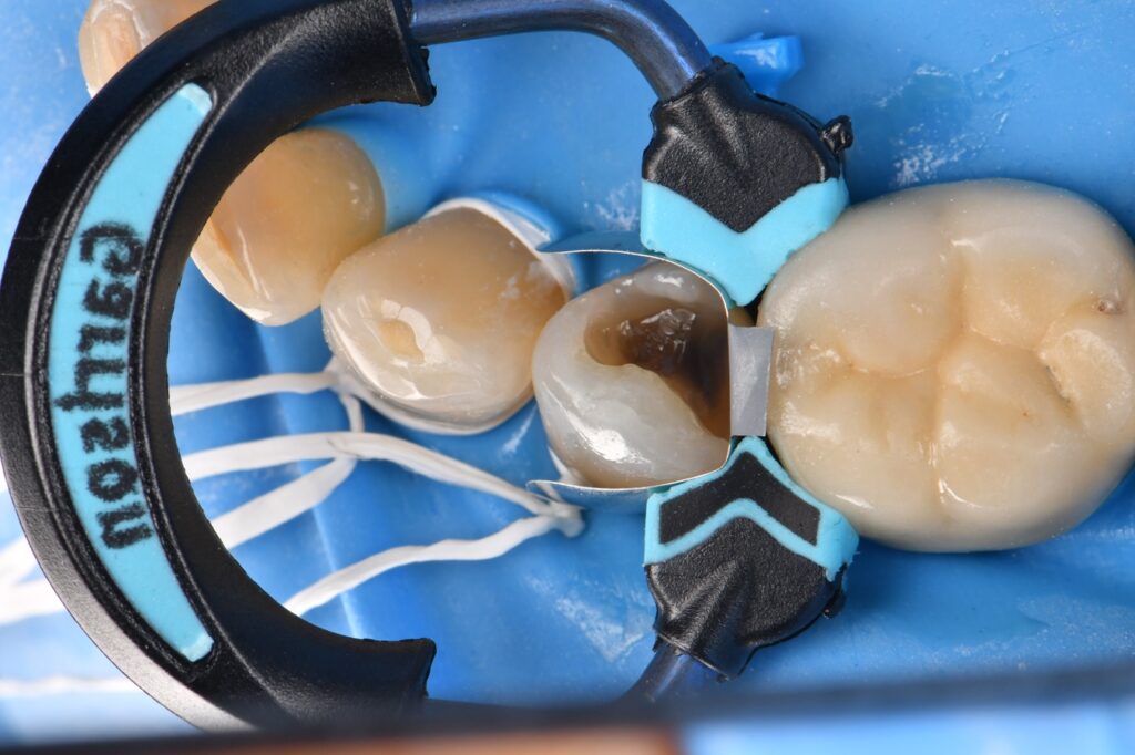 Garrison Quad Matrix system in Class II restorative situation