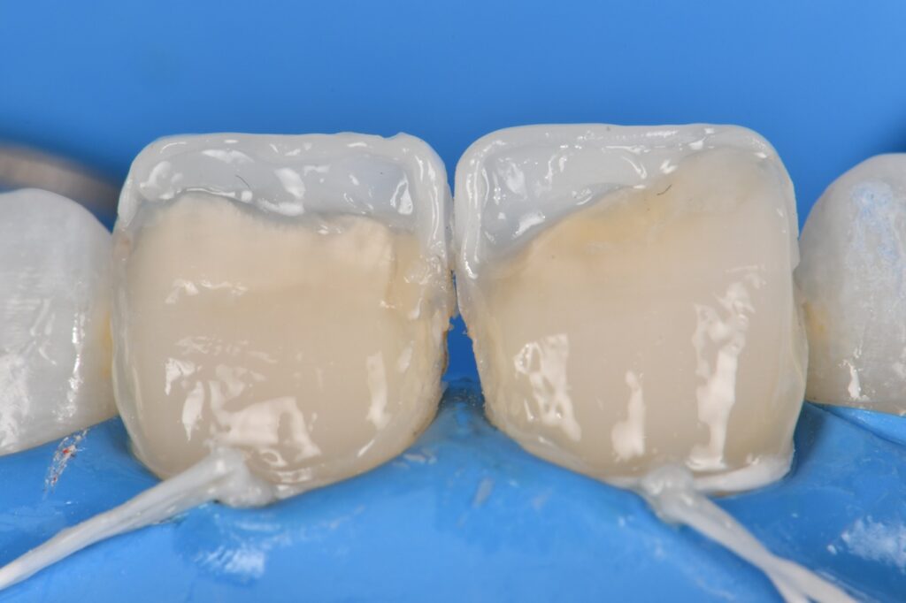 Ultradent Forma Composite Veneers Zirconia Nanohybrid