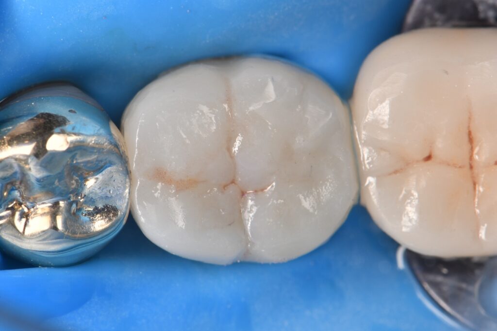 Implant Access Closure with Composite Sequence