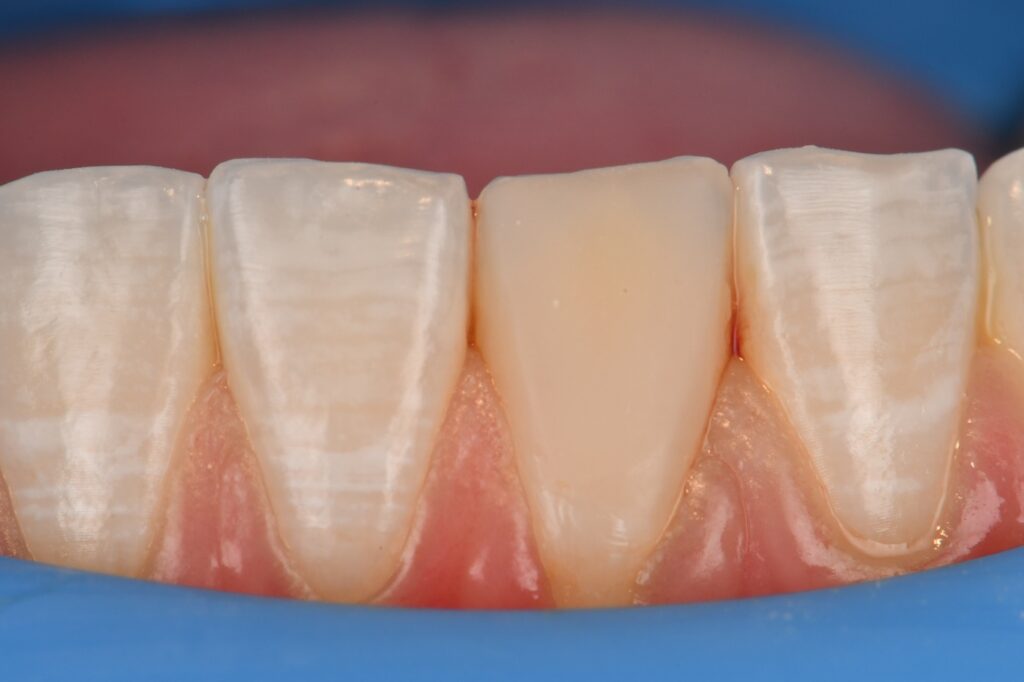 Inserting maverick effects into a layered composite veneer