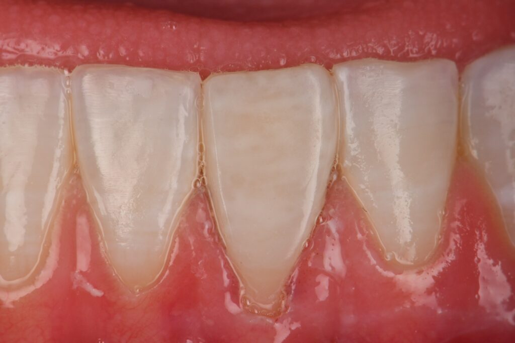 Inserting maverick effects into a layered composite veneer