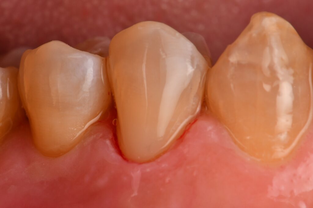 The threshold depth for restoration of cervical abrasion lesions