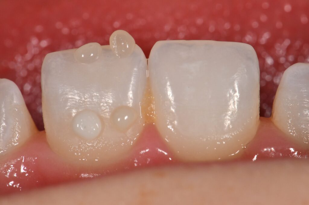 Peg lateral incisors corrected non-invasively