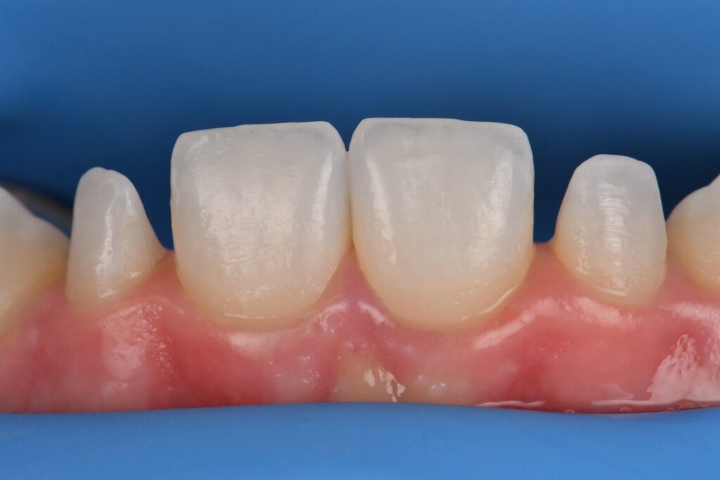 Peg lateral incisors corrected non-invasively