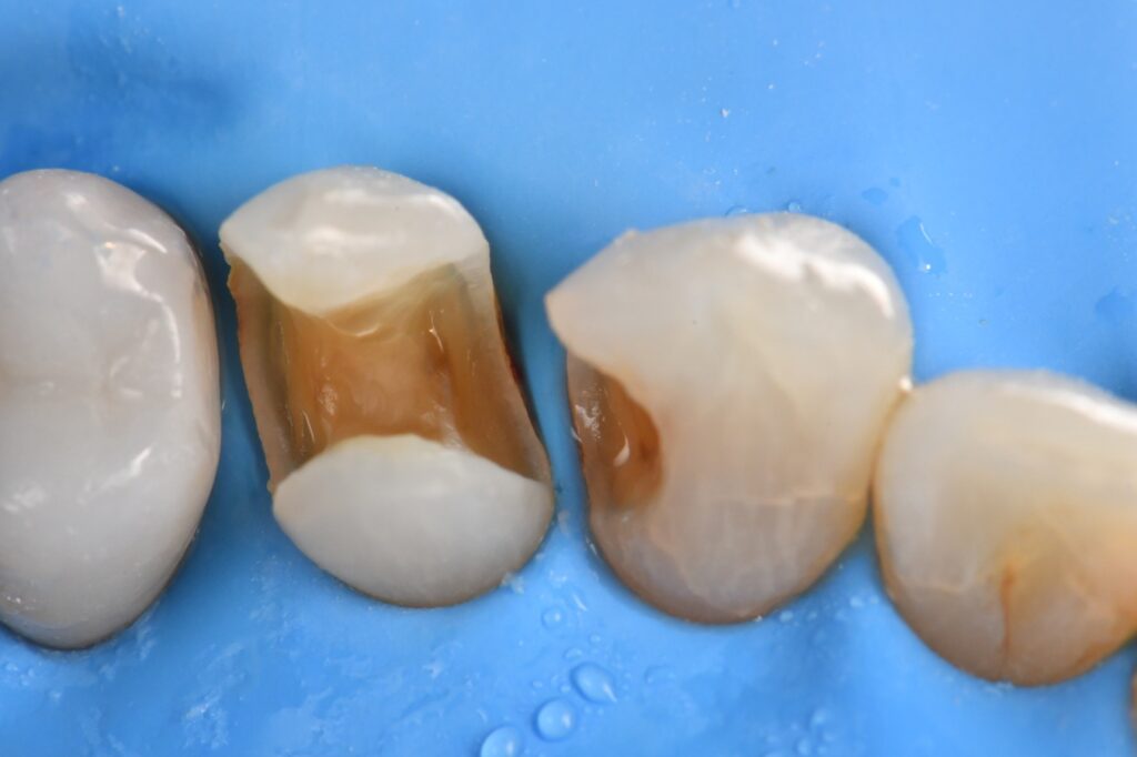 Garrison Quad Matrix back to back Class II restorations