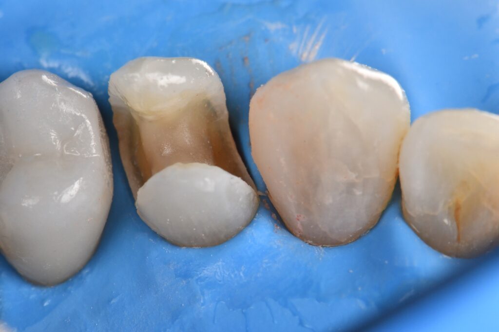 Garrison Quad Matrix back to back Class II restorations