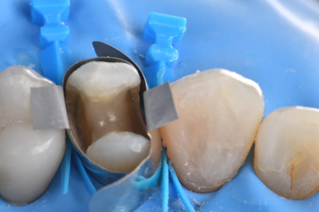 Garrison Quad Matrix back to back Class II restorations