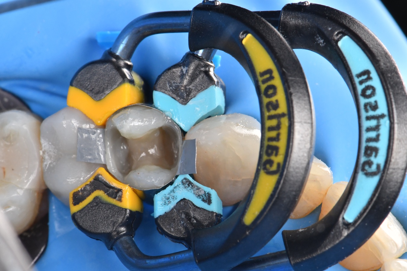 Garrison Quad Matrix back to back Class II restorations