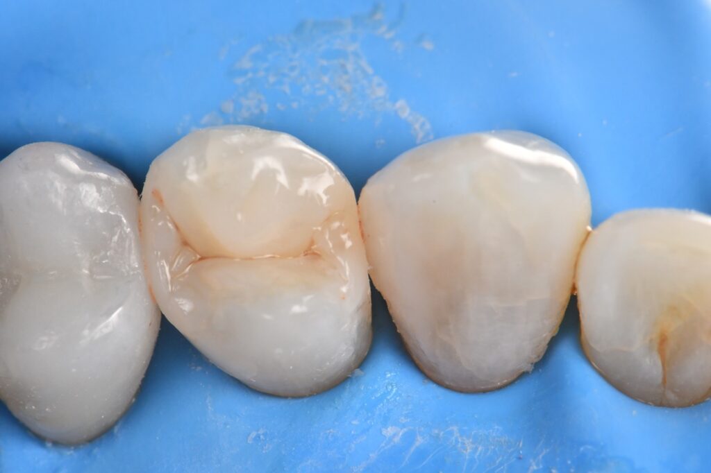Garrison Quad Matrix back to back Class II restorations