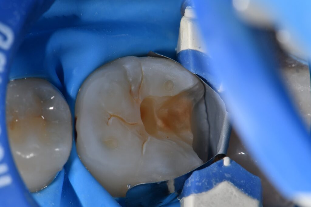 Peripheral rim fracture and secondary caries