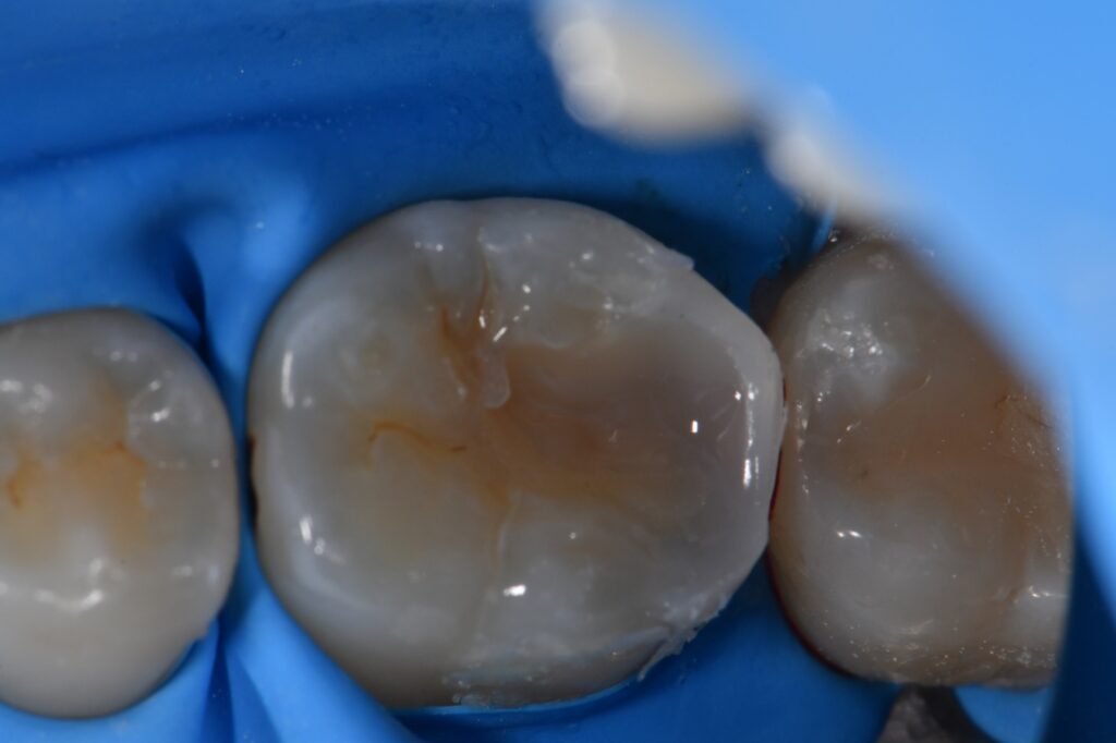 Peripheral rim fracture and secondary caries