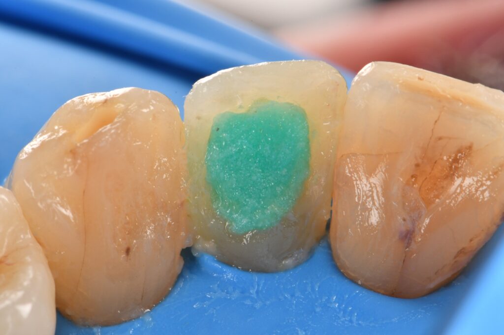 Internal Bleaching and Composite reconstruction