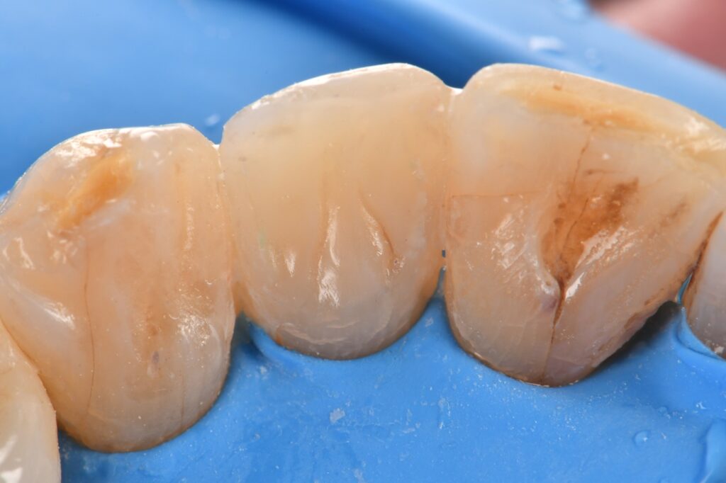 Internal Bleaching and Composite reconstruction