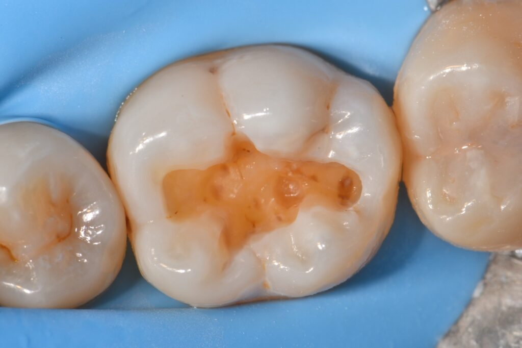 Sequential Lobe Technique Direct Composite