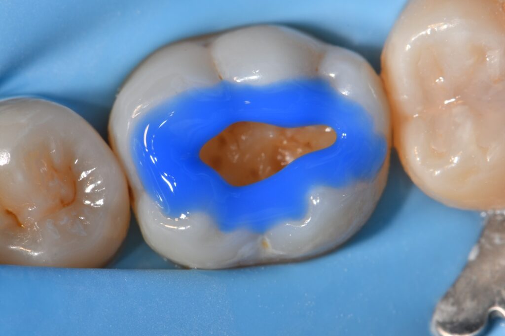 Sequential Lobe Technique Direct Composite