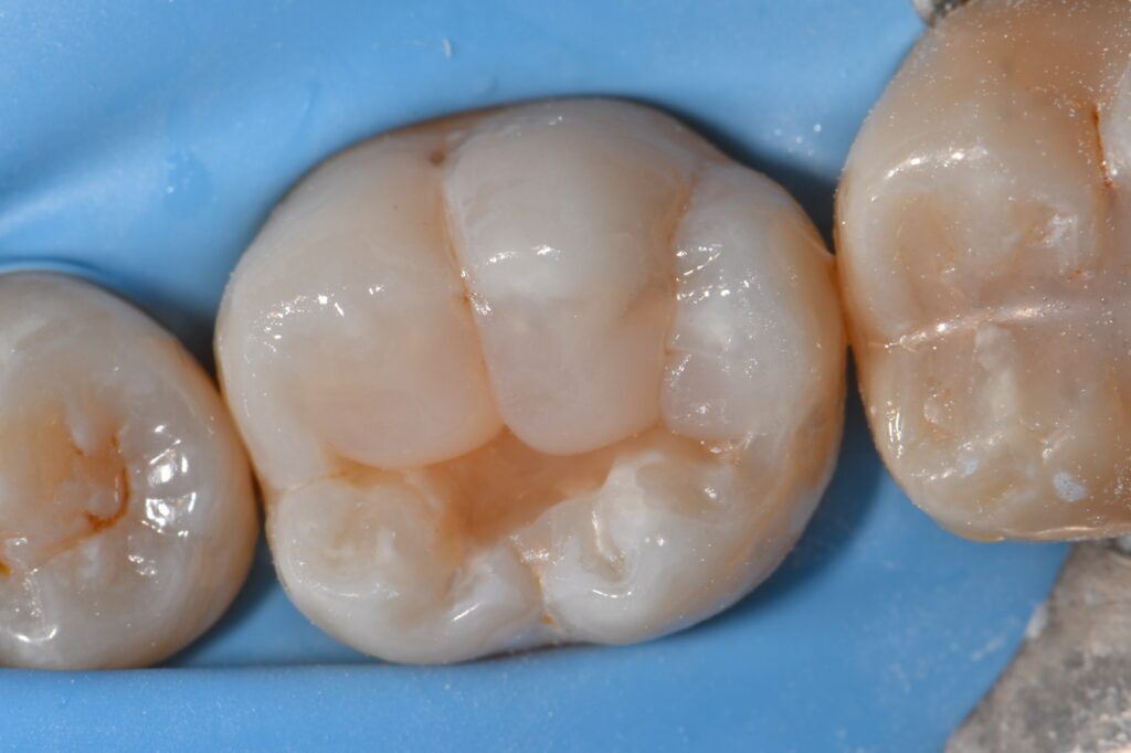 Sequential Lobe Technique Direct Composite
