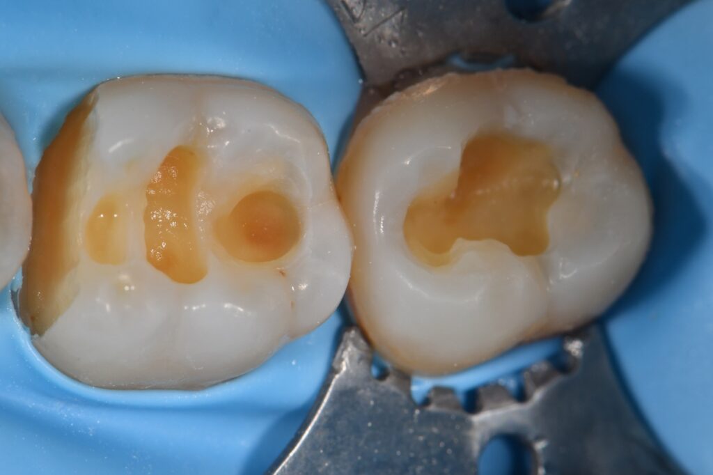 Deep Margin Elevation | Cervical ringbark caries