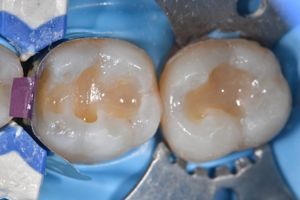 Deep Margin Elevation | Cervical ringbark caries